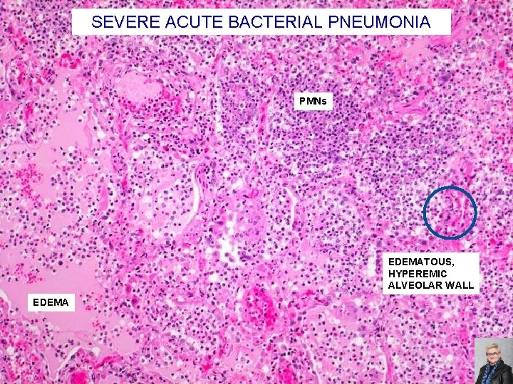 Lower Respiratory Tract Infections Part 2 Bacterial infections