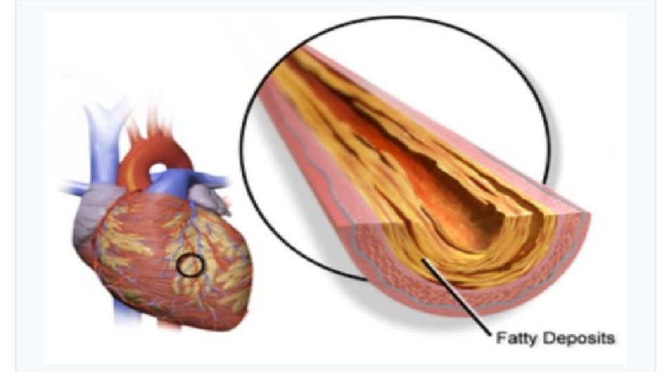 DEFINITION 13 HEART MUSCLE BUILDUP OF PLAQUE ARTERIES