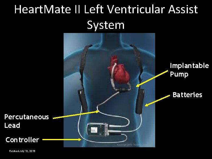HENRY FORD HOSPITAL Ventricular Assist Device Program Emergency