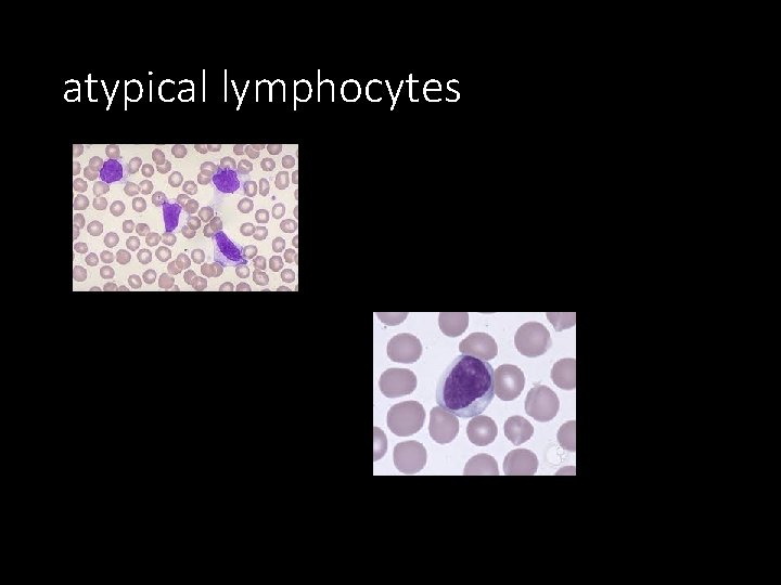 INFECTIOUS MONONUCLEOSIS Dr R Bindhusaran Associate professor DEPT