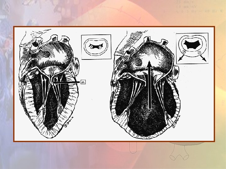 Mitral Valve Anatomyimportant Anatomic Relationship The functional ...