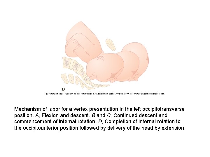 Manual removal of the placenta The abdominal hand