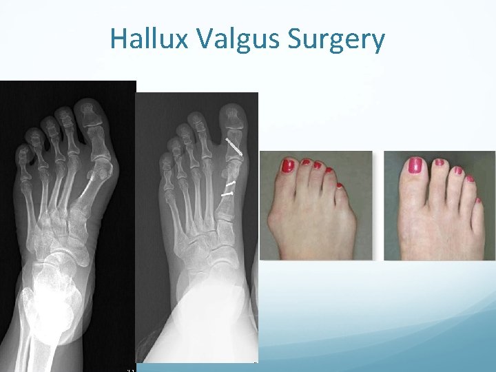 Common Foot and Ankle Disorders Abdulaziz Almaawi MD