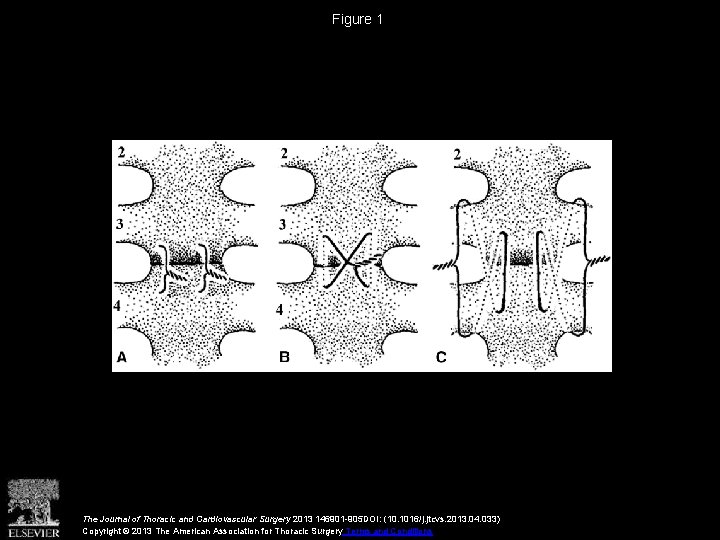 Crossed wiring closure technique for bilateral transverse thoracosternotomy