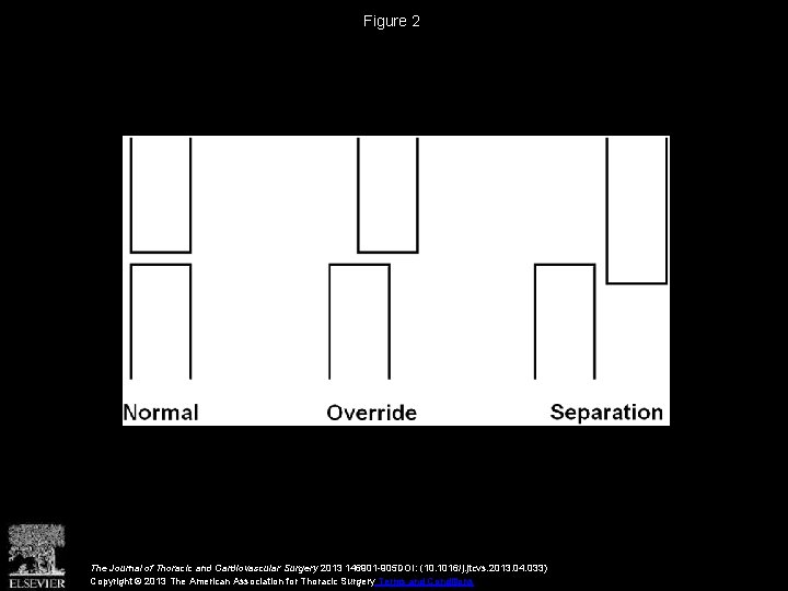 Crossed wiring closure technique for bilateral transverse thoracosternotomy