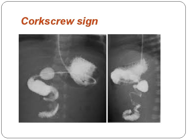 Pediatric gastrointestinal bleeding Saja Saraireh Abrar Areed Amer