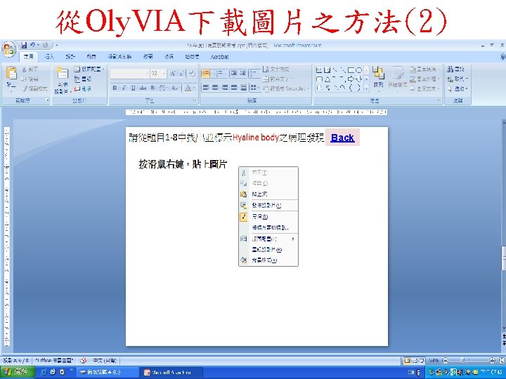 1 8 1 Radicular cyst with hyaline body