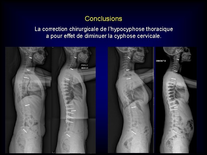 Alignement sagittal du rachis cervical dans la scoliose