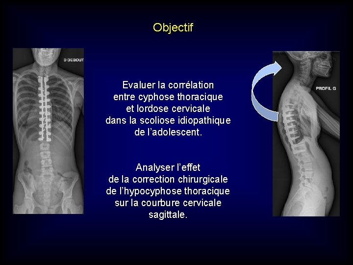 Alignement sagittal du rachis cervical dans la scoliose