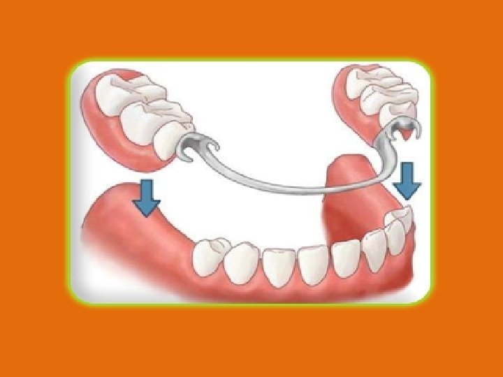 Replacement of partial defects of dentition with bugel