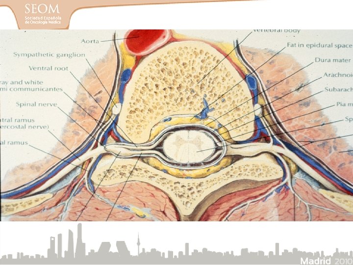 EL TRATAMIENTO MULTIDISCIPLINAR DE LA COMPRESIN MEDULAR CM