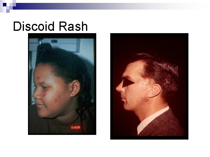 Systemic Lupus Erythematosus BY ABDULLAH RADWAN SLE n