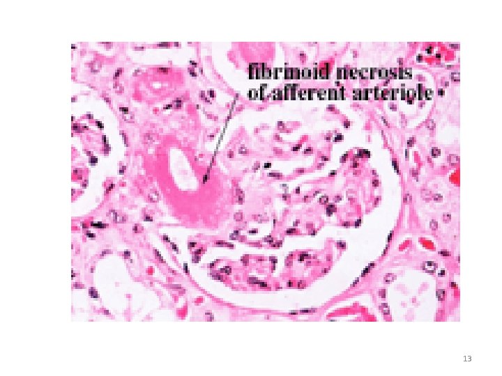 Diseases of Kidney Blood Vessels 1 Arterionephrosclerosis The