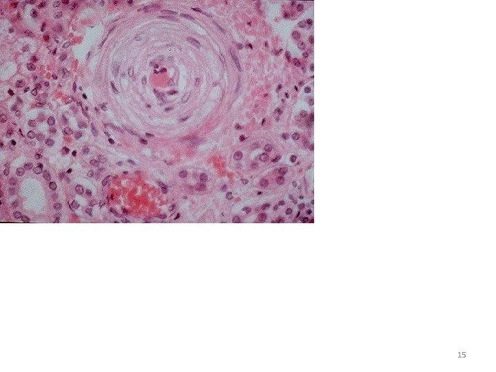 Diseases of Kidney Blood Vessels 1 Arterionephrosclerosis The