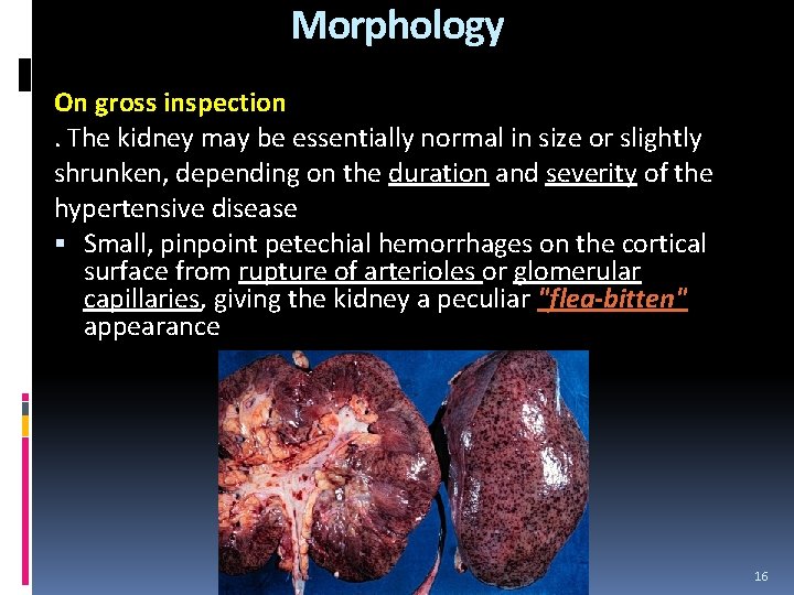Diseases of Kidney Blood Vessels 1 Arterionephrosclerosis The