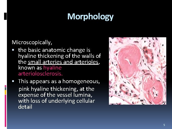 Diseases of Kidney Blood Vessels 1 Arterionephrosclerosis The