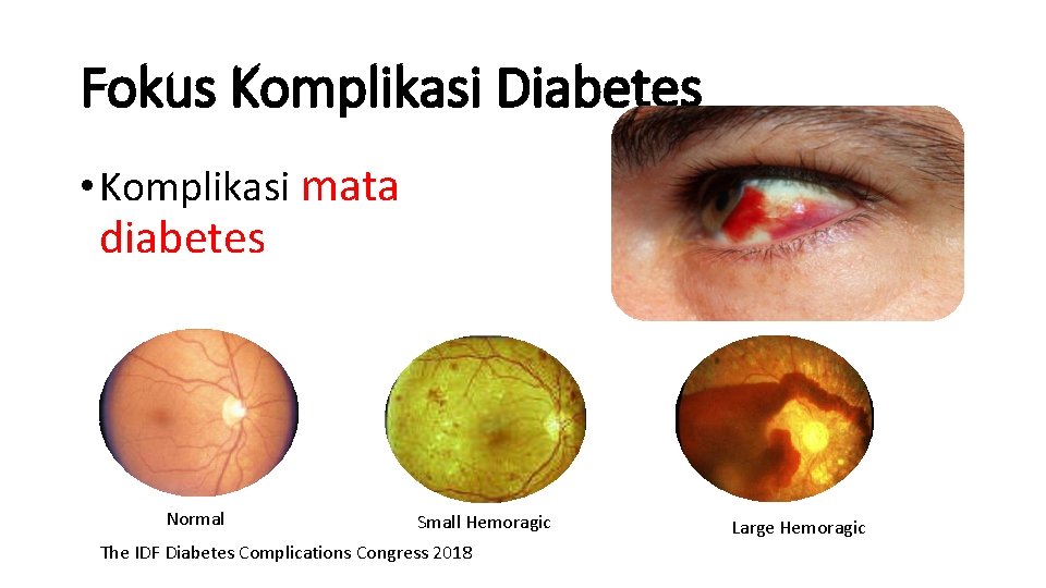 DIABETES Management Cronic Complication and Self Management Education