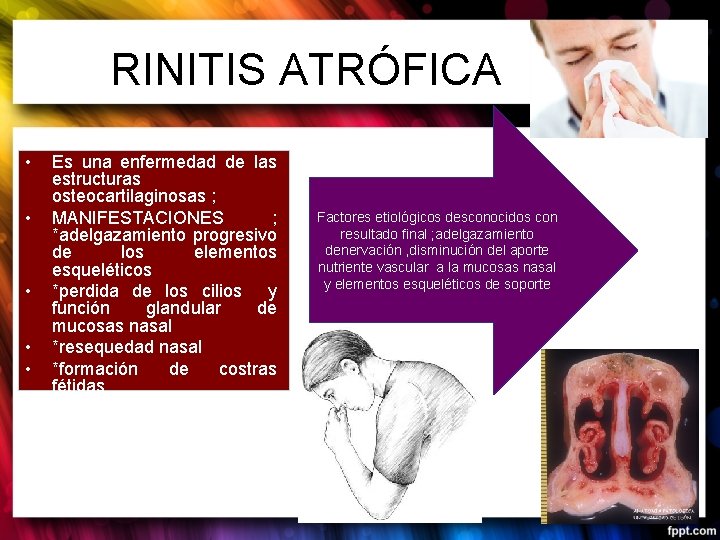 Infecciones nasales cronicas INFECCIONES NASALES RINITIS ATRFICA Es