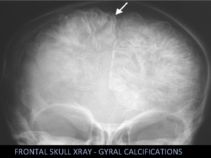 PHAKOMATOSES 2 Z Sturge Weber syndrome encephalotrigeminal angiomatosis