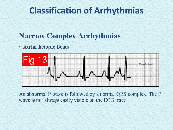 ECG Monitoring By Dr Ahmed Mostafa Assist Prof