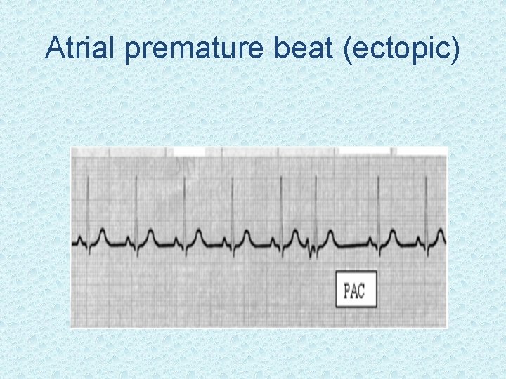 ECG Monitoring By Dr Ahmed Mostafa Assist Prof