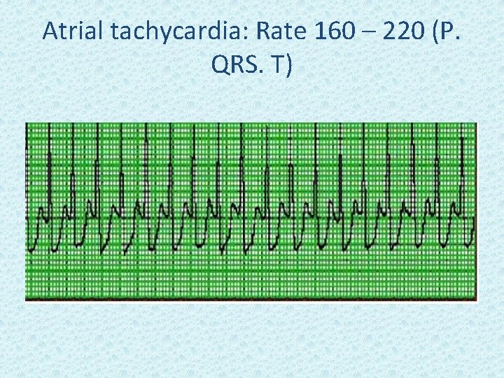 ECG Monitoring By Dr Ahmed Mostafa Assist Prof