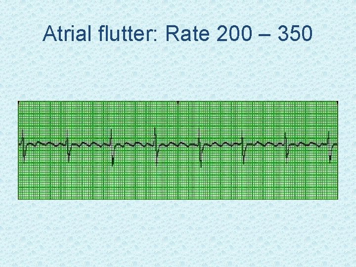 ECG Monitoring By Dr Ahmed Mostafa Assist Prof