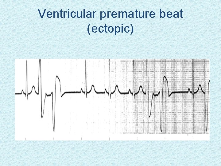 ECG Monitoring By Dr Ahmed Mostafa Assist Prof