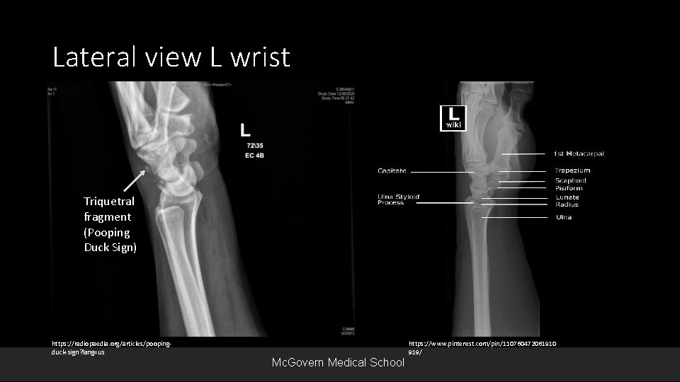 Acute Triquetral Fracture and Radiocarpal Subluxation Jason Fuller