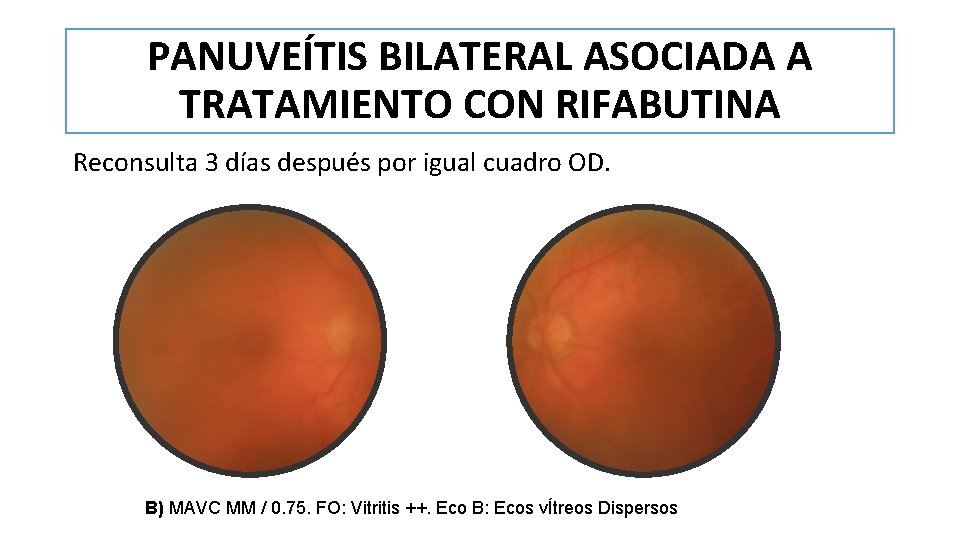 PANUVETIS BILATERAL ASOCIADA A TRATAMIENTO CON RIFABUTINA A