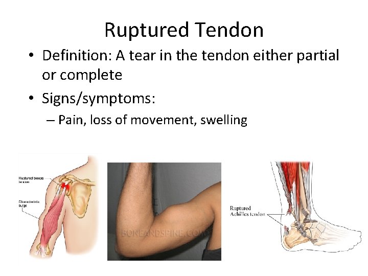Joint Injuries Sprain General Info Most common injury