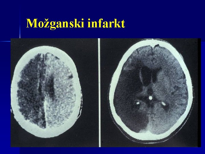 Cerebrovaskularni inzult CVI mara popovicmf unilj si 1162022