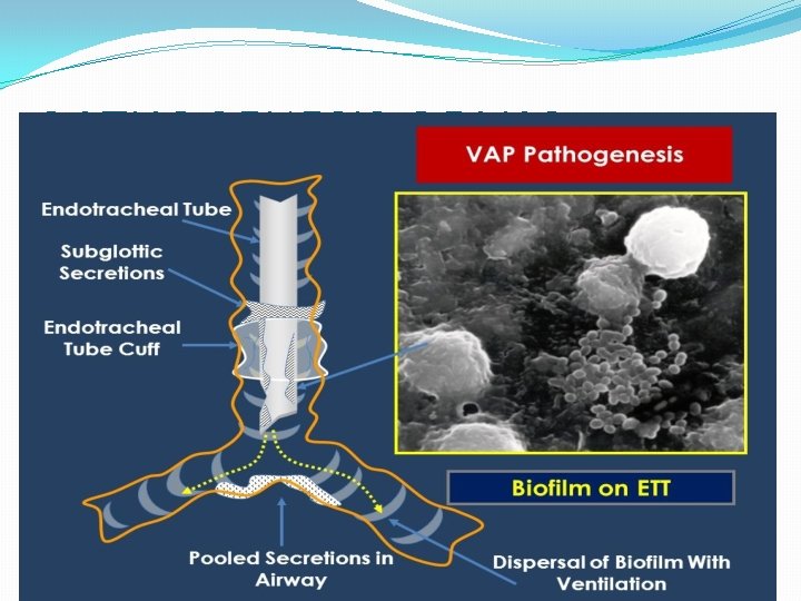 VENTILATOR ASSOCIATED PNEUMONIA PREVENTABLE DISEASE DR RAWAL MAHENDRA
