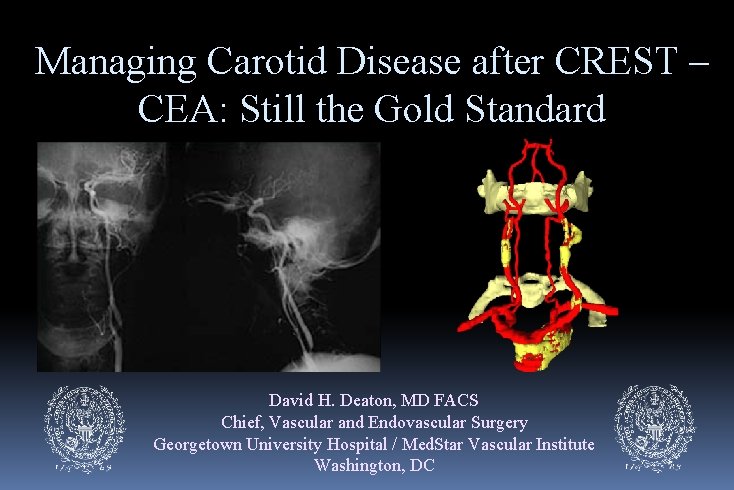 Managing Carotid Disease after CREST CEA Still the