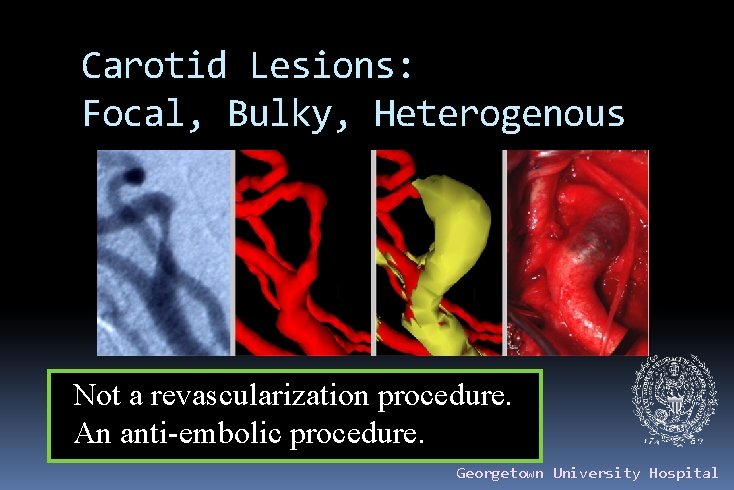 Managing Carotid Disease after CREST CEA Still the