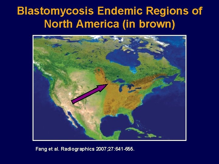 Human Blastomycosis Surveillance in Minnesota 1999 2010 Carrie