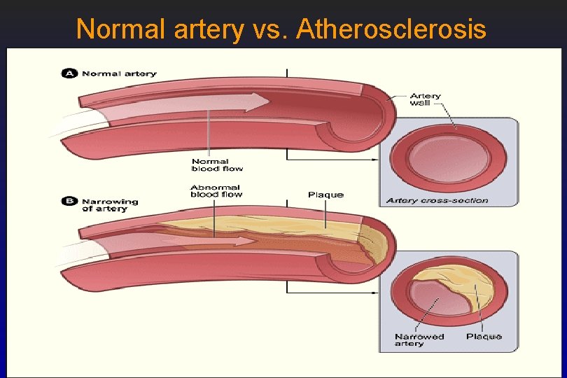 EPDM 566 Epid of CVD Pathobiology of Atherosclerosis