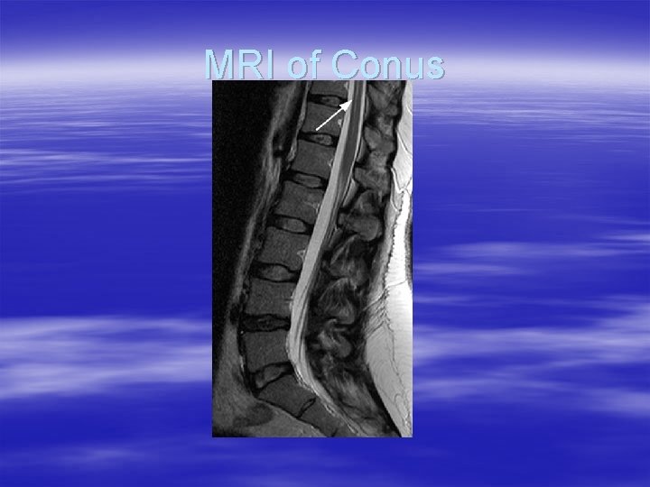 Post Partum Nerve Injury A Quick Guide Incidence