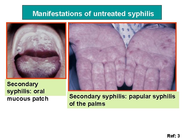 Understand 1 Virulence factor of bacteria 2 Koch