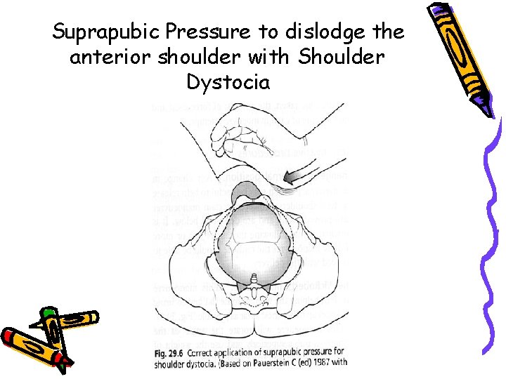 Intrapartum Emergencies Max Brinsmead MB BS Ph D