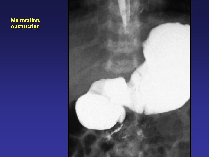 Abdominal Emergencies in Pediatric Ayman AlJazaeri Pediatric Surgery