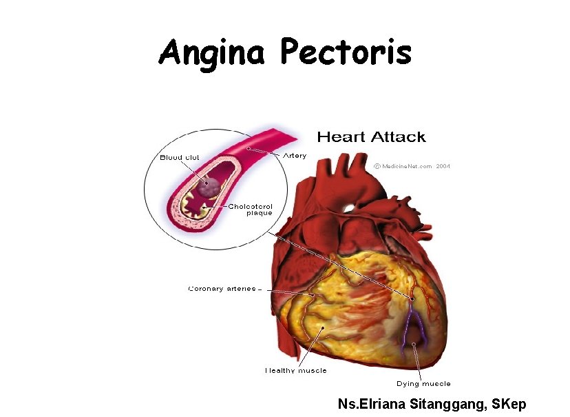 Angina Pectoris Ns Elriana Sitanggang SKep Definisi Angina
