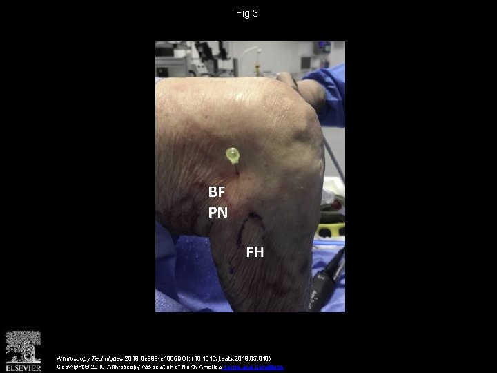 An AllArthroscopic Technique for Complex Posterolateral Corner ...