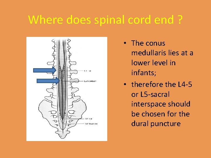 Paediatric spinal anaesthesia clinical pearls Dr S Parthasarathy