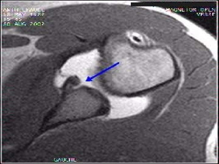 GH Dislocation Open Bankart Lesion Repair in a
