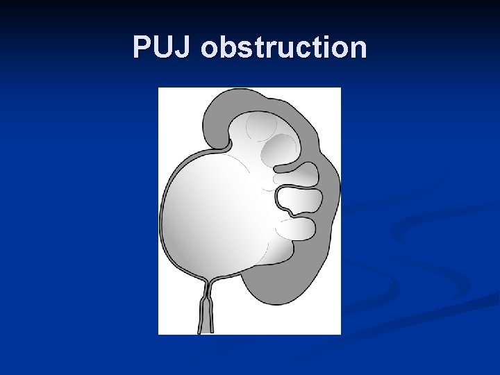 ANTENATAL HYDRONEPHROSIS Prof Hashem AlMomani Pediatric Surgeon JORDAN