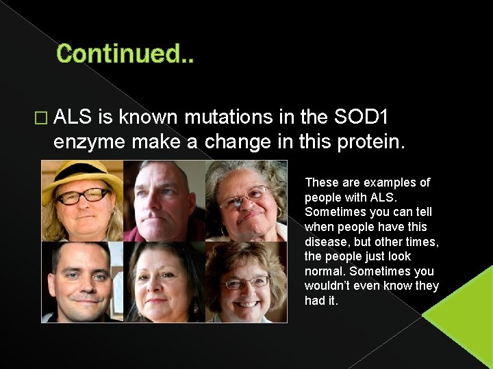 ALS Amyotrophic lateral sclerosis Biology A Presentation By