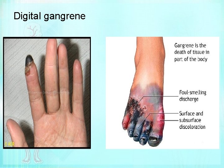 AN INTRODUCTION TO VASCULITIS DR NASIR FAROOQ BUTT