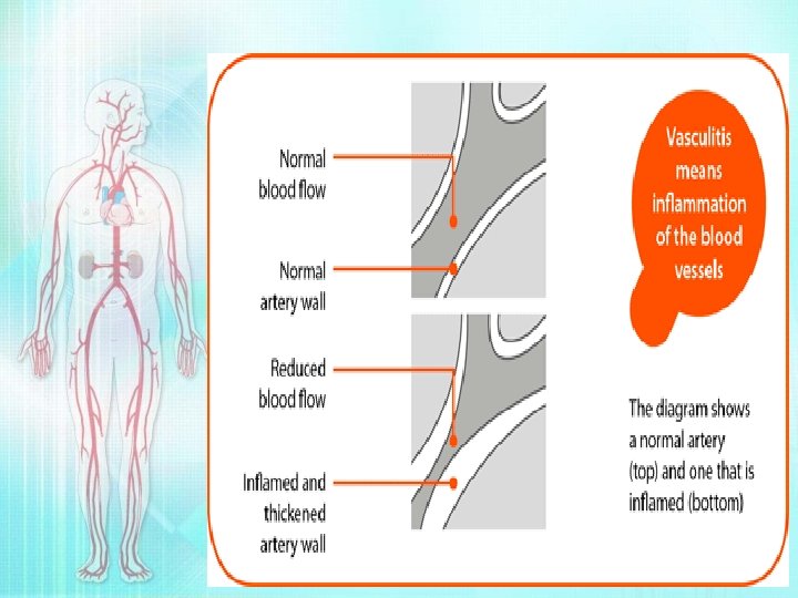 AN INTRODUCTION TO VASCULITIS DR NASIR FAROOQ BUTT