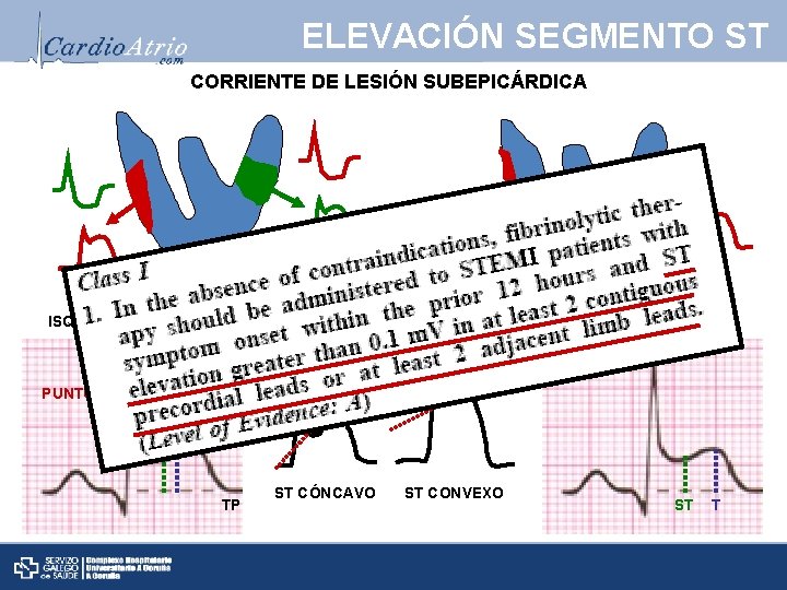 SESIONES DE ELECTROCARDIOGRAFA ELEVACIN DEL SEGMENTO ST DIAGNSTICO